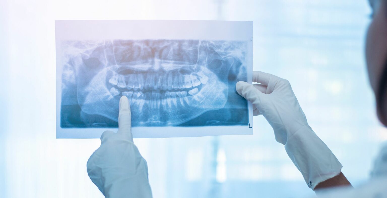 OPG Dental X-rays: A Guide to This Vital Scan
